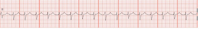 EKG Rhythm Strips 28: Junctional Rhythms