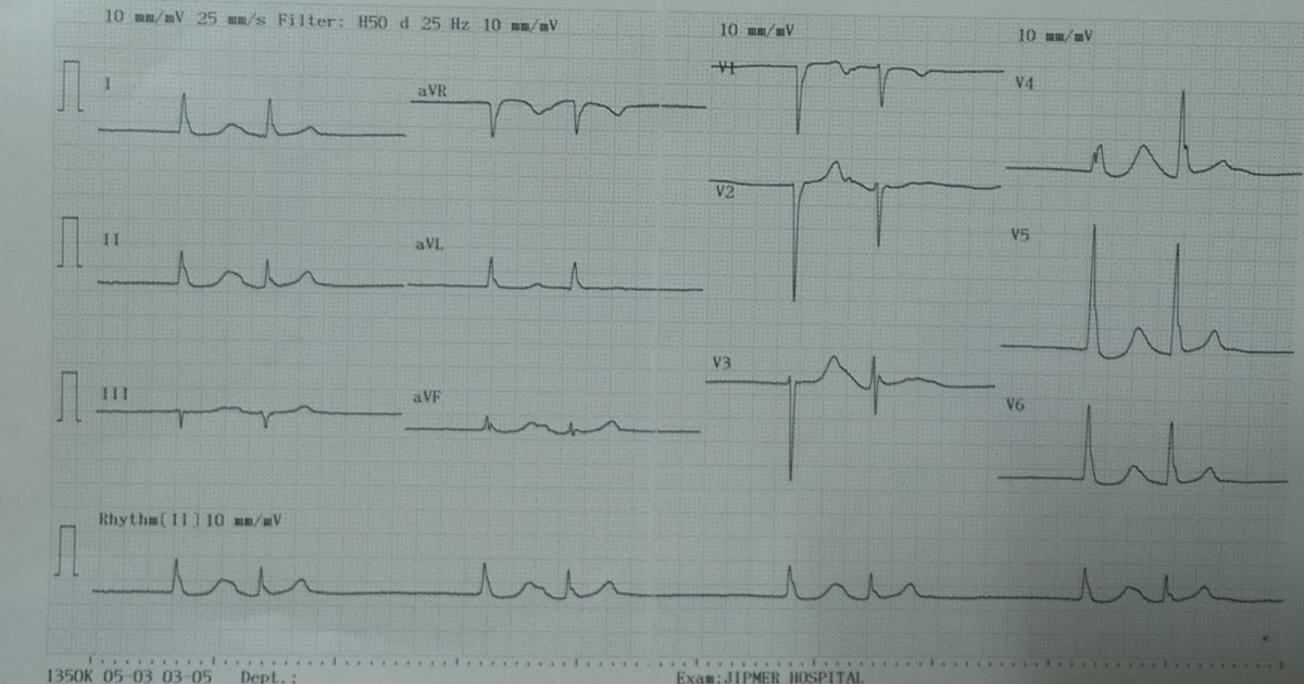 Cardiology window: Sinus node dysfunction