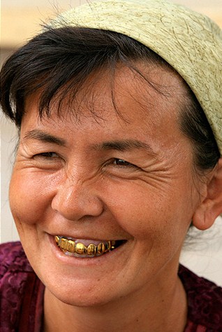 Deformutilation: Women with Gold Teeth