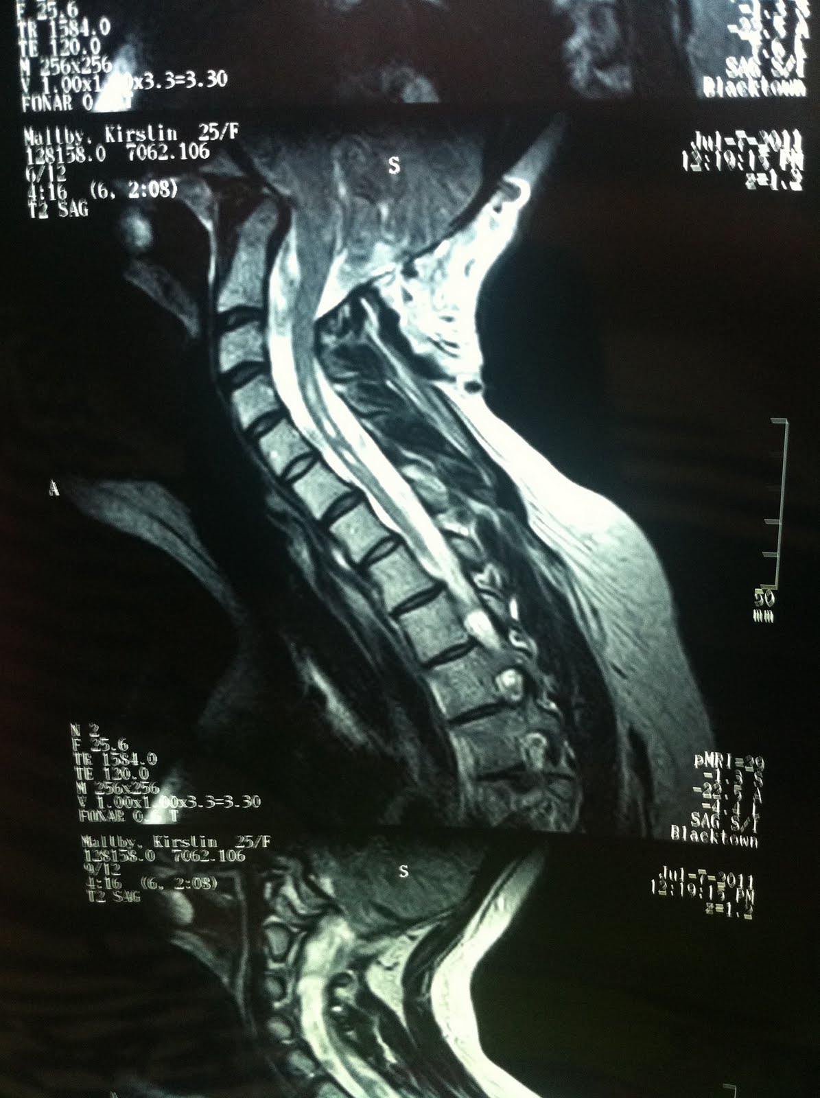 Chiari & Syringomyelia Australia: MRI's