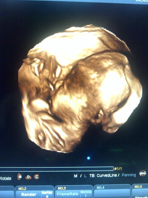 KLINIK PRATAMA MAKMUR JAYA: USG Bayi /Kehamilan dengan USG 2,3 4 DIMENSI