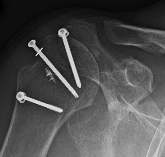 UW Shoulder and Elbow Academy: Reverse total shoulder - is there a need ...