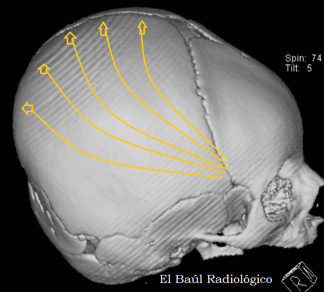 El Baúl Radiológico: CRANEOSINOSTOSIS. CIERRE PREMATURO DE LAS SUTURAS ...