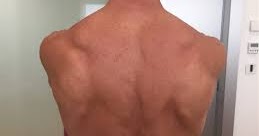 SALUD Y MEDICINA: La Plexitis Braquial a propósito de un caso clínico