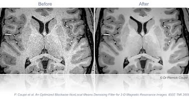 Digital Image Restoration: Medical image restoration