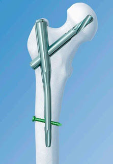 PFN PFNA PFNA2 TFN differences and features