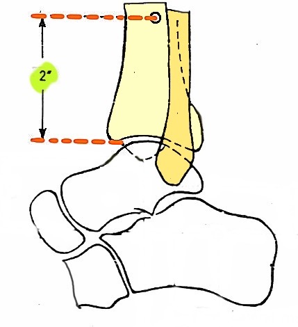 Skeletal Traction Pin Site Care