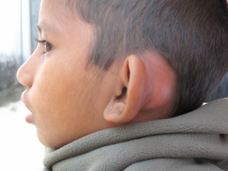 ENT for medical students: ENT PICTURES - EAR