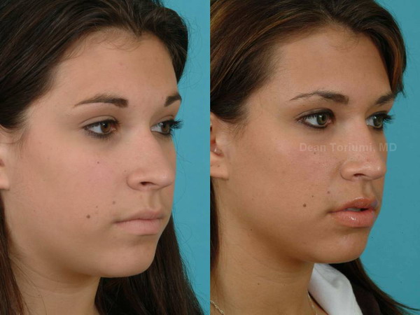 Dr. Dean Toriumi Reviews: Dr. Toriumi's operation to correct the ...
