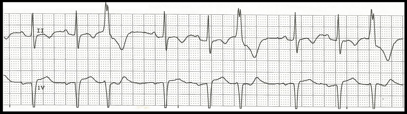 EKG Rhythm Strip Quiz 153