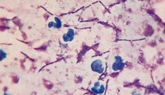 Bacillus Anthracis.