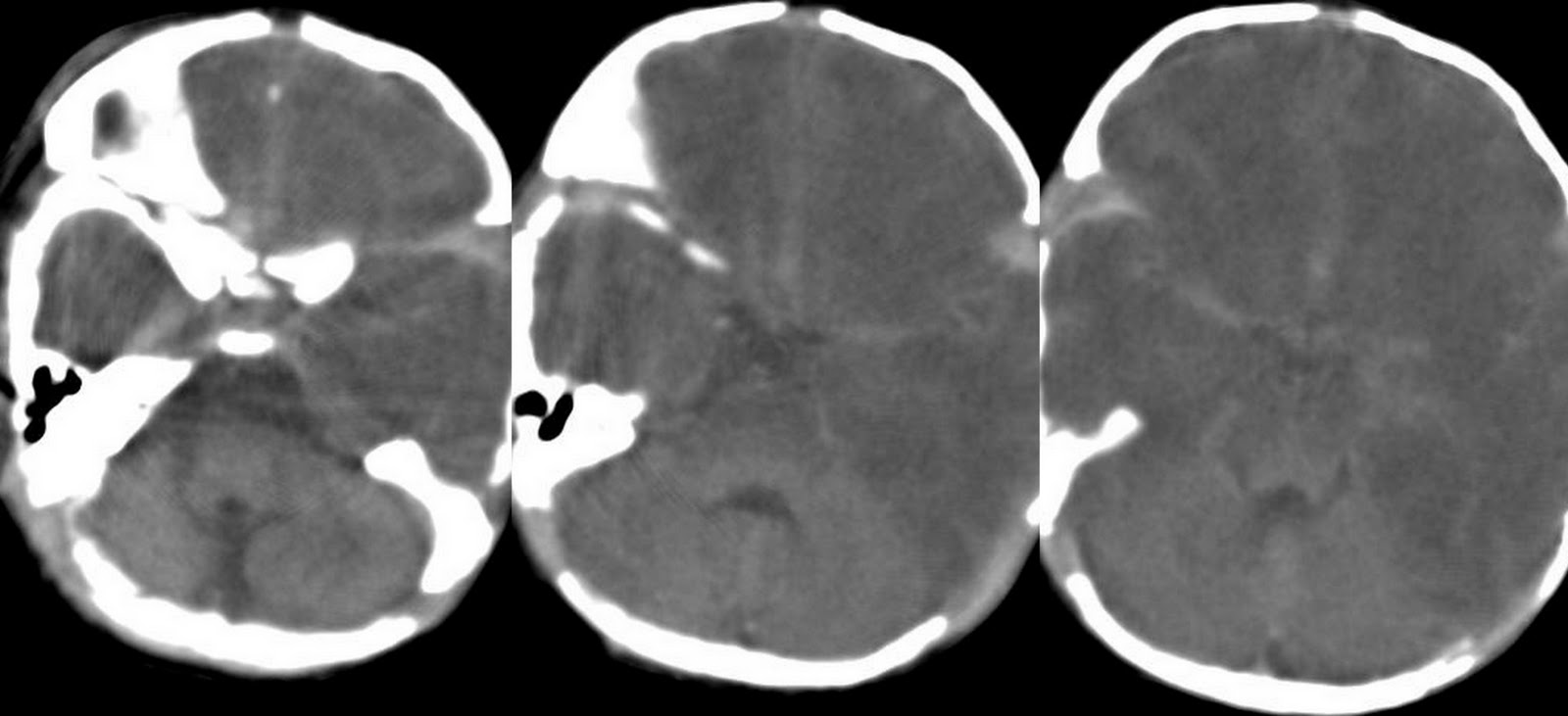 Dr Balaji Anvekar FRCR: Global Cerebral Hypoxia