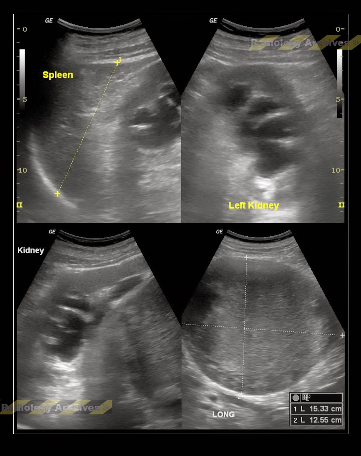 Radiology Archives: Καρκίνωμα εκ Νεφρικών Κυττάρων (Υπερνέφρωμα - Όγκος ...