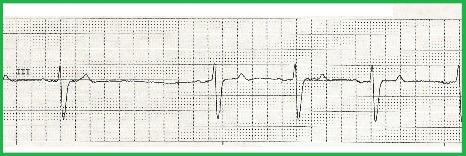 Characteristics of Sinus Rhythms