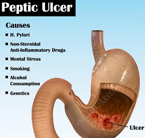 Peptic Ulcer