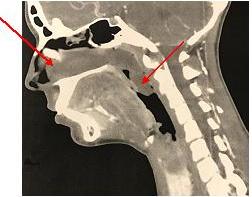 AAEM Resident and Student Association : Case Report: Antrochoanal Polyp