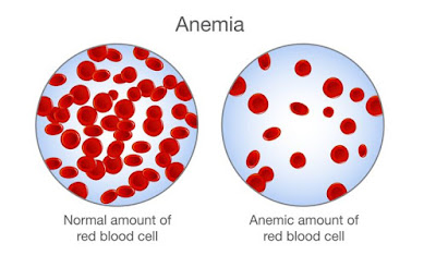 7 Signs of Anemia That You May Not Be Aware Of And How To Treat It ...