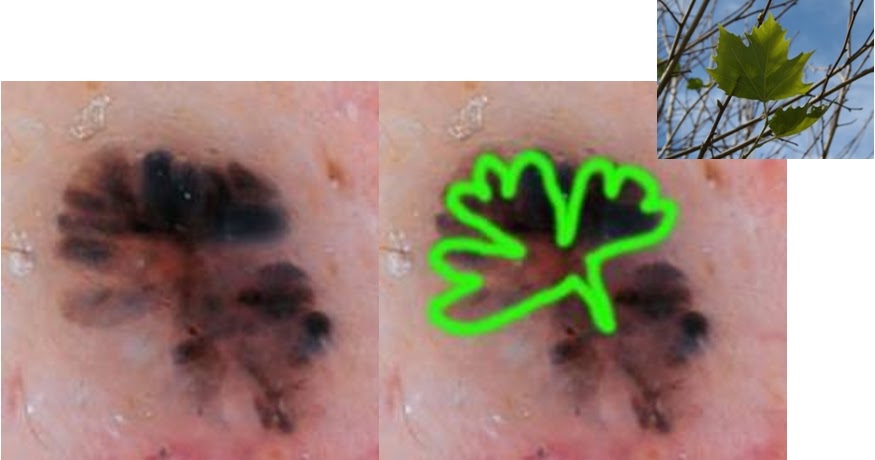 Dermatoscopia: Maple leaflike areas