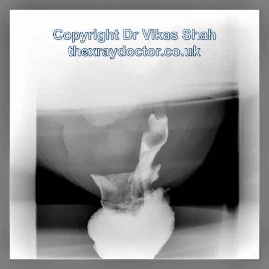 the xray doctor: Pelvic floor imaging part 4: what is a rectal prolapse?