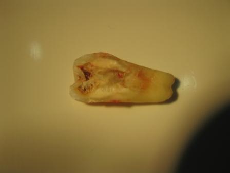 Schön Dental: Molar Hemisektion and restoration (by Drg. Henri Mudjono)