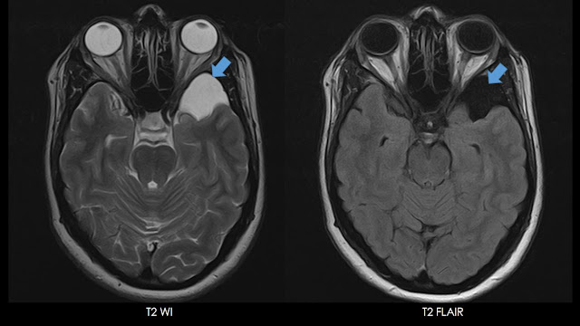 Ultimate Radiology : Intracranial Arachnoid Cyst : Galassi Type I
