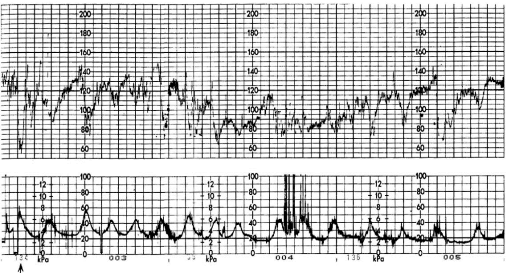 học Y: monitoring sản khoa (CTG