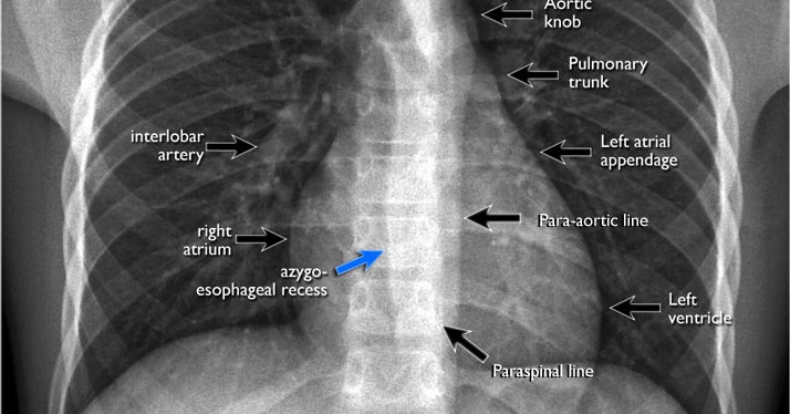 ¿Sabemos leer una RX de tórax? Parte 1: Recuerdo anatómico ...