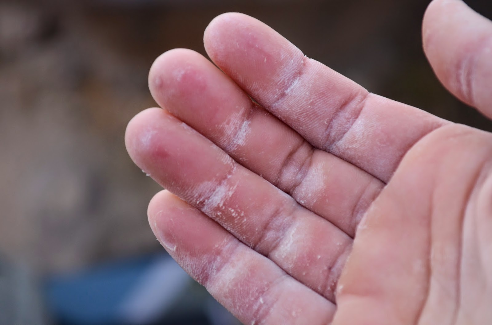 What's happening with Graham and Kim?: Finger injuries.... ouch.