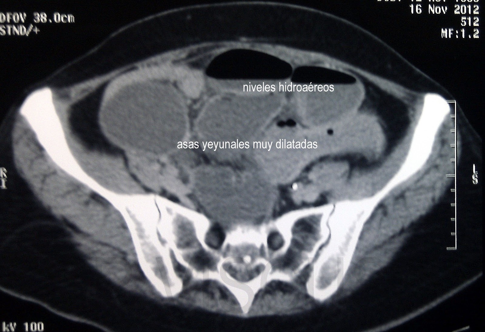 Que vi hoy: Imágenes de obstrucción intestinal