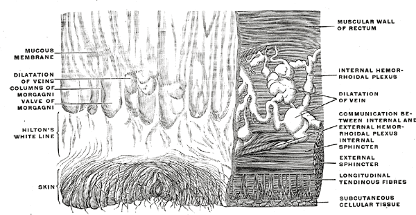 Enfermedad hemorroidal: teoría, clínica, y tratamiento. - AnSRo