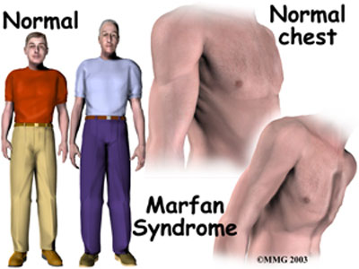 Health And Diseases Blog: Marfan Syndrome
