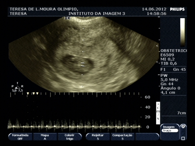 Que venha o bebê!: Primeiro ultrassom