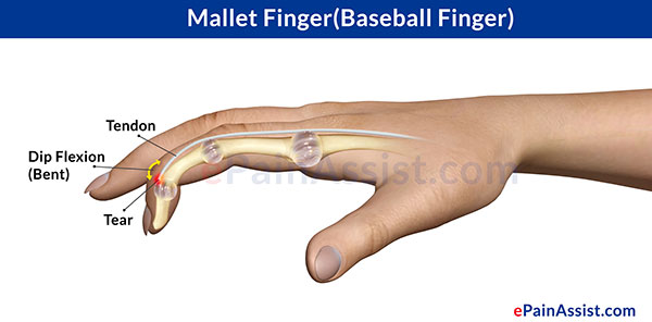 Mallet Finger