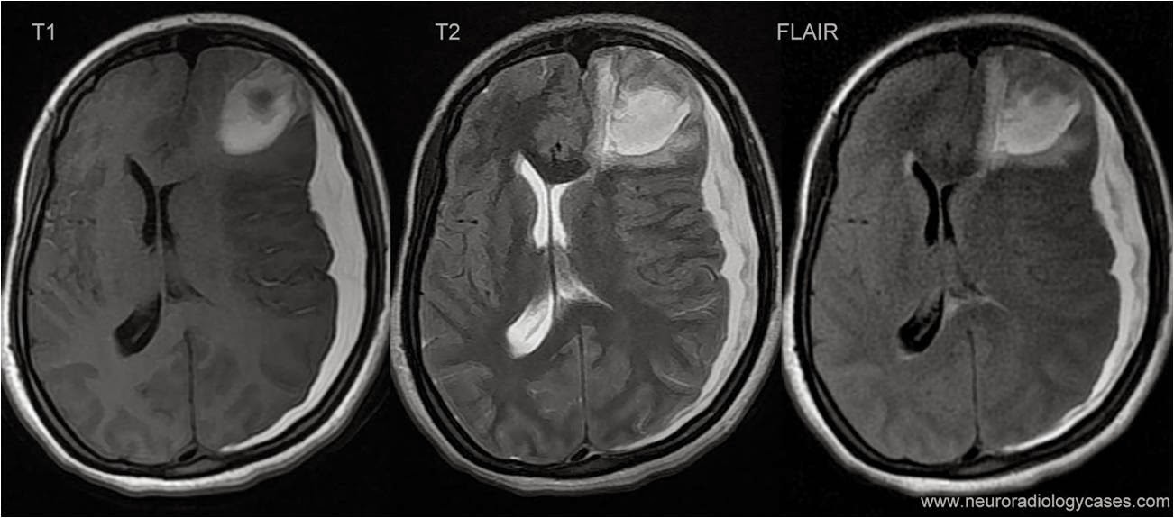 Brain Bleed: Brain Bleed On Mri