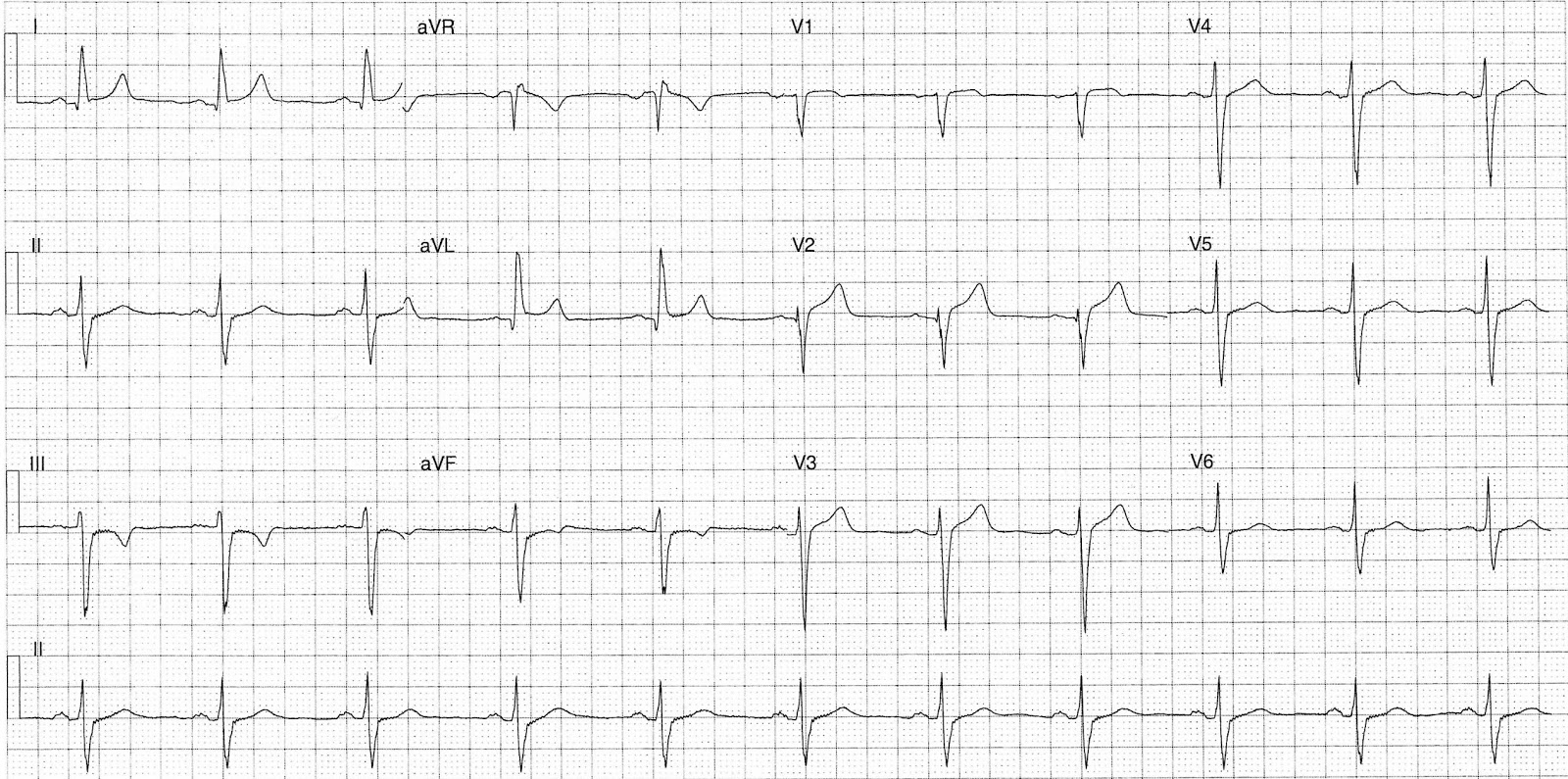 ECG of the Week: ECG of the Week - 1st August 2016 - Interpretation