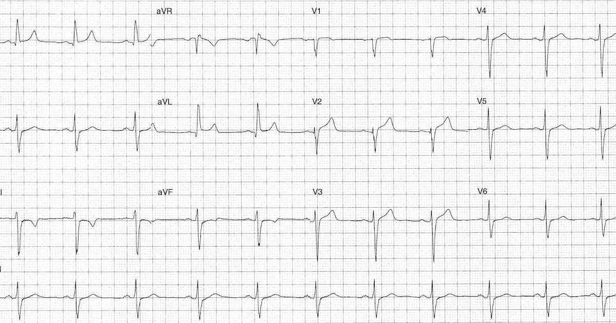 ECG of the Week: ECG of the Week - 1st August 2016 - Interpretation