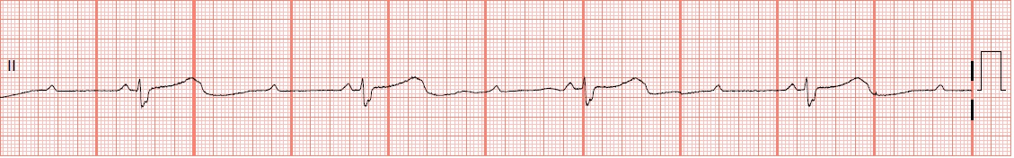 EKG Rhythm Strips 30: Heart Block Challenge Part I