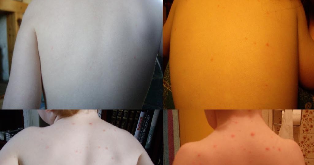 The Brick Castle: Chicken Pox for Beginners....