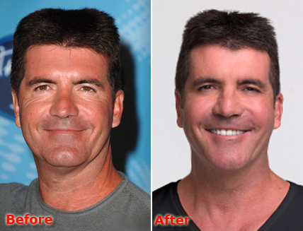 Chatter Busy: Simon Cowell Plastic Surgery