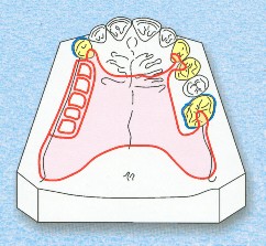 Analisis y Diseño Biomecánico de la PPR ~ Comunidad Odontológica