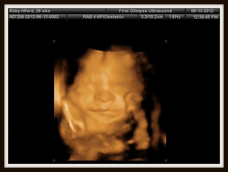 Us + Two: 25 Weeks 6 Days- 3D Ultrasound