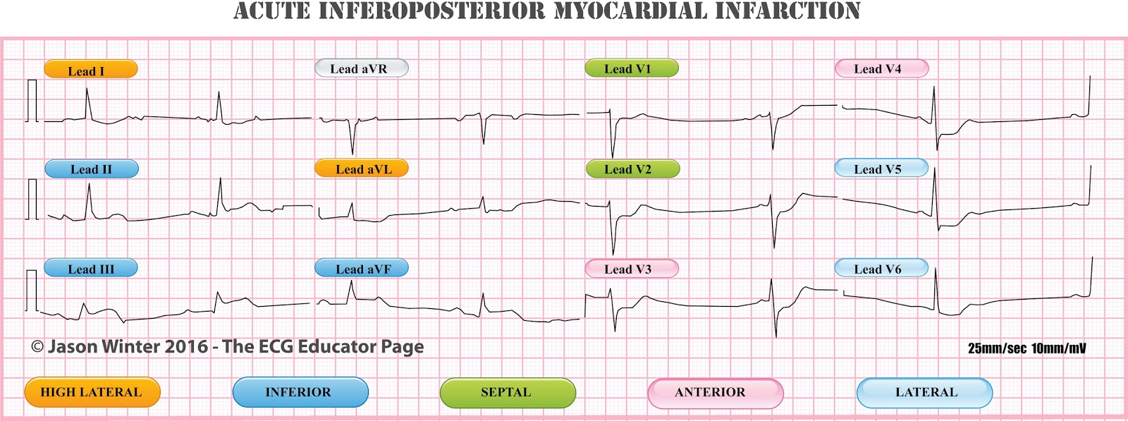 ECG Educator Blog : Acute coronary syndrome and infarctions