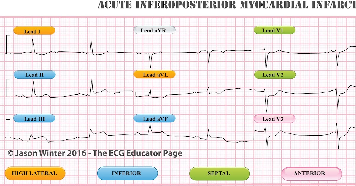 ECG Educator Blog : Acute coronary syndrome and infarctions