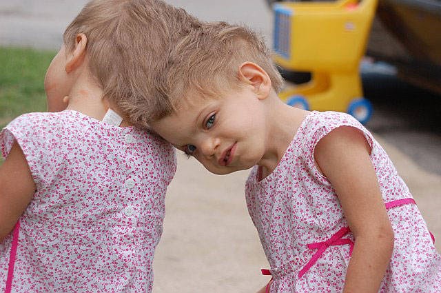 Craniopagus conjoined twins |Daily Pictures