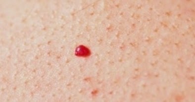 Sepa por qué es preferible eliminar los lunares rojos a laser - ¿Y cómo ...