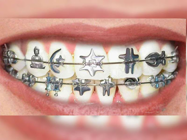 10 estilos de brackets que están de moda, lucirás hermosa con los #5