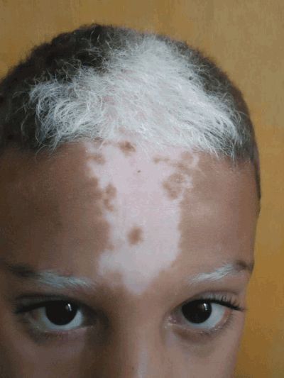 Definicion Poliosis, Sintomas, Causas y Tratamiento