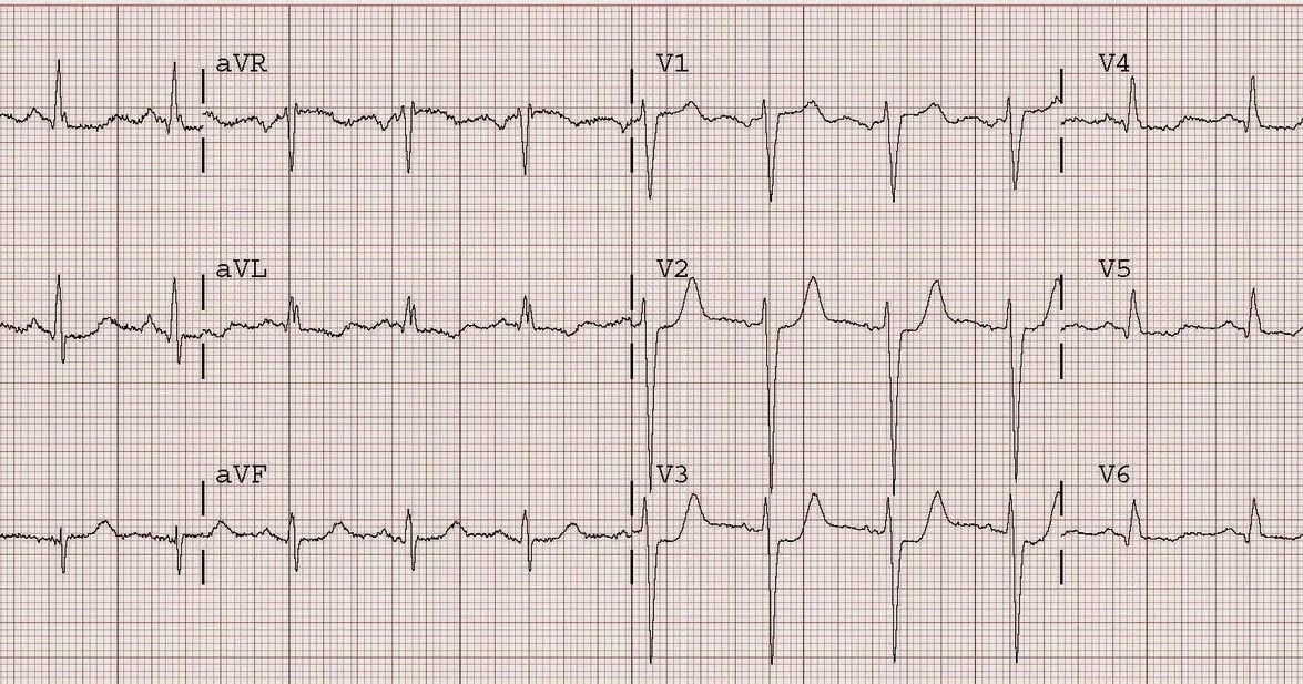 Dr. Smith's ECG Blog: Pure (Isolated) Posterior STEMI -- not so rare ...