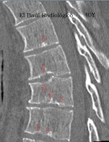 El Baúl Radiológico: ENFERMEDAD DE SCHEUERMANN (DORSALGIA JUVENIL ...