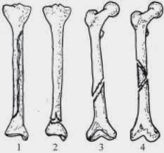 FRACTURAS: que son las fracturas?
